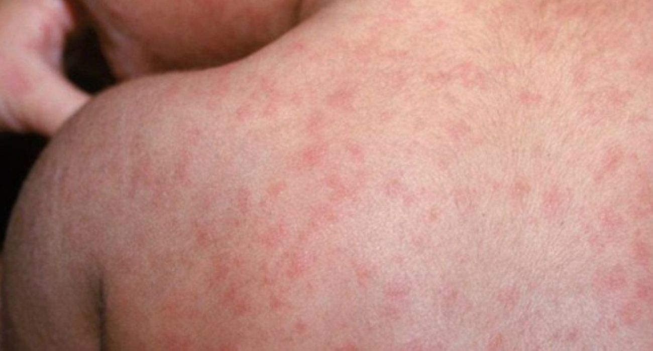 Busca Secretaría de Salud frenar el sarampión antes de noviembre