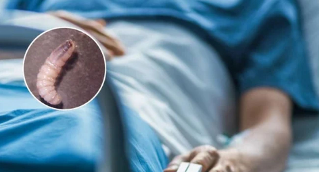 Suben casos de miasis por gusano barrenador en humanos en Chiapas