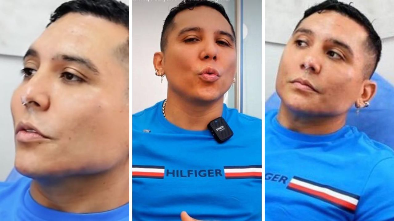 Edwin Luna se realiza retoque estético y lo tunden en redes