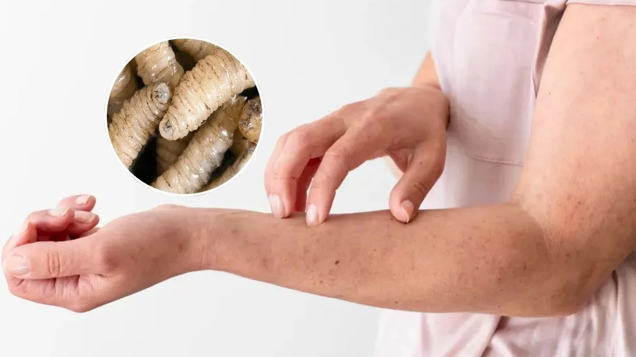 Aumentan a 39 casos de miasis por gusano barrenador en humanos