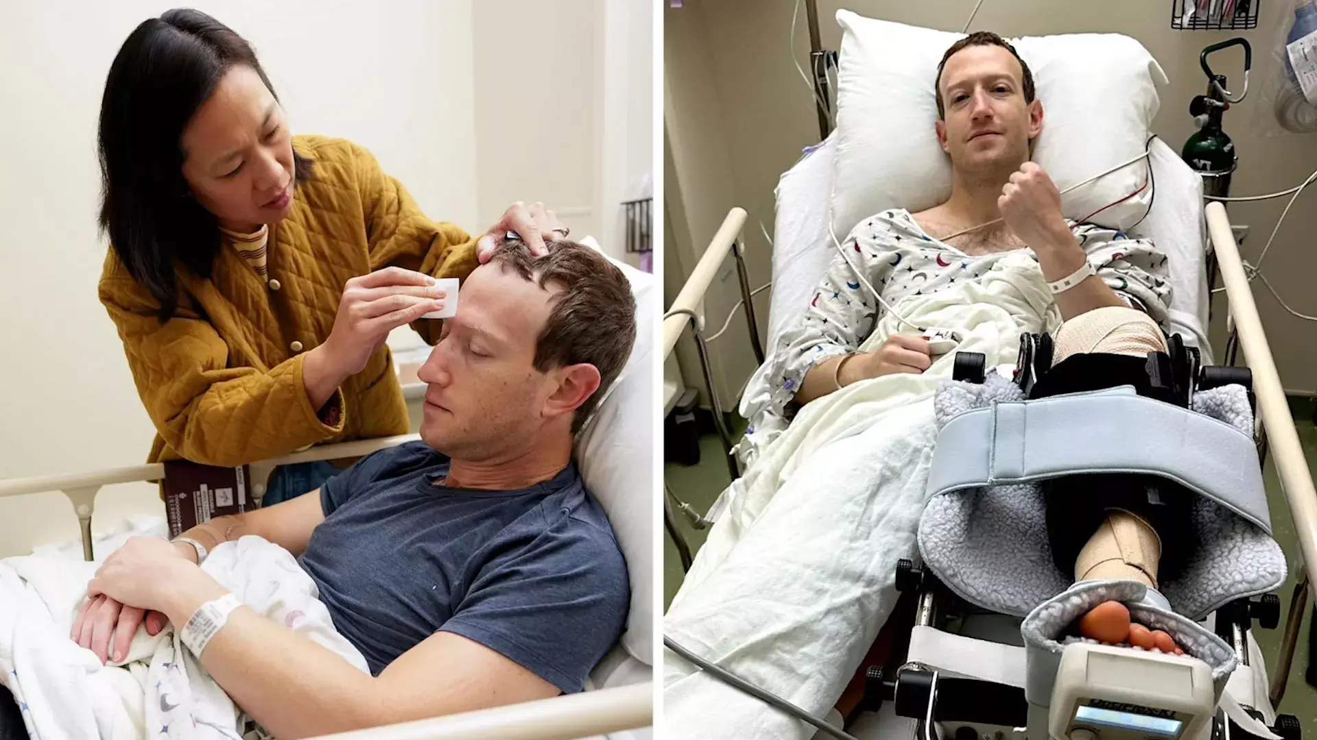 Someten a cirugía a Mark Zuckerberg por lesión